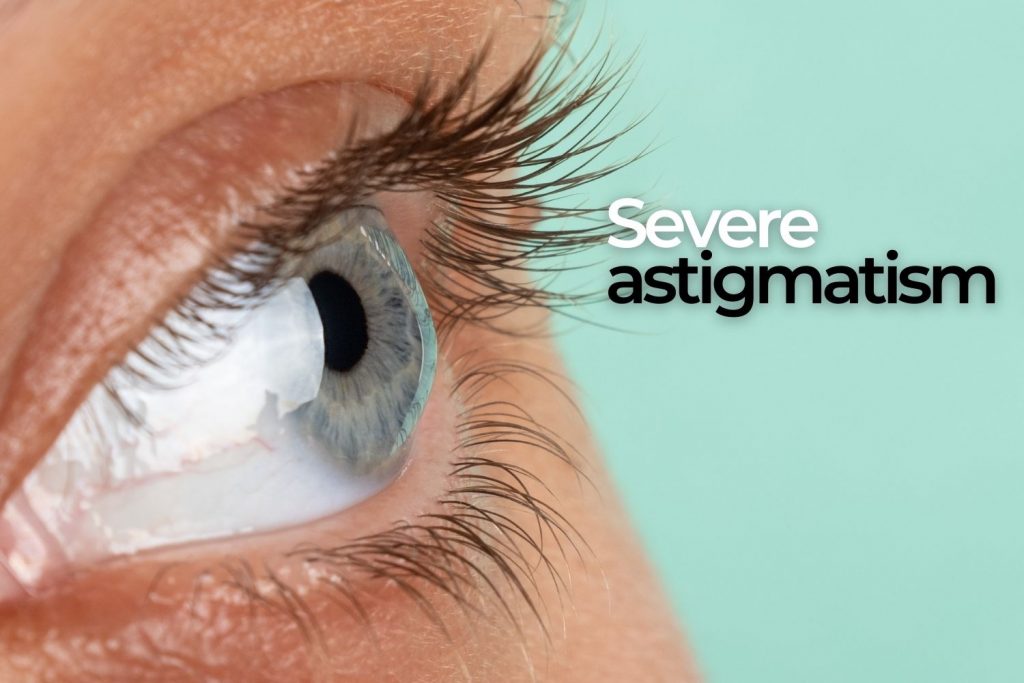 Severe Astigmatism: What Can Be Done to Correct It? | EZOnTheEyes