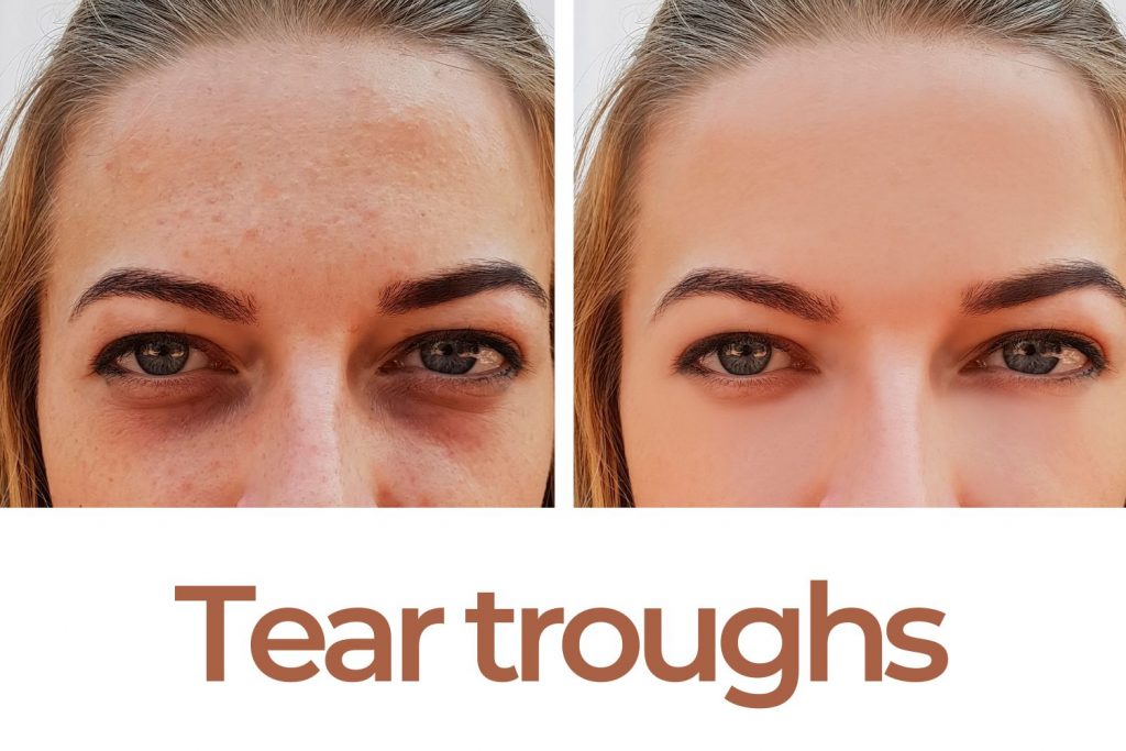 What Are Tear Troughs and How To Get Rid of Them | EZOnTheEyes