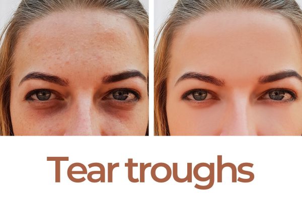 What Are Tear Troughs and How To Get Rid of Them | EZOnTheEyes