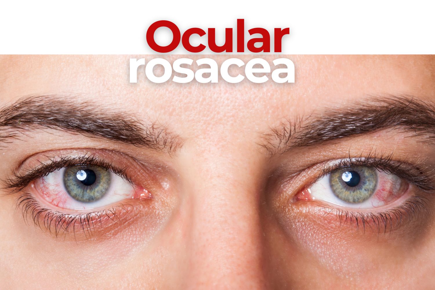 What is Ocular Rosacea? What You Should Know - EZOnTheEyes