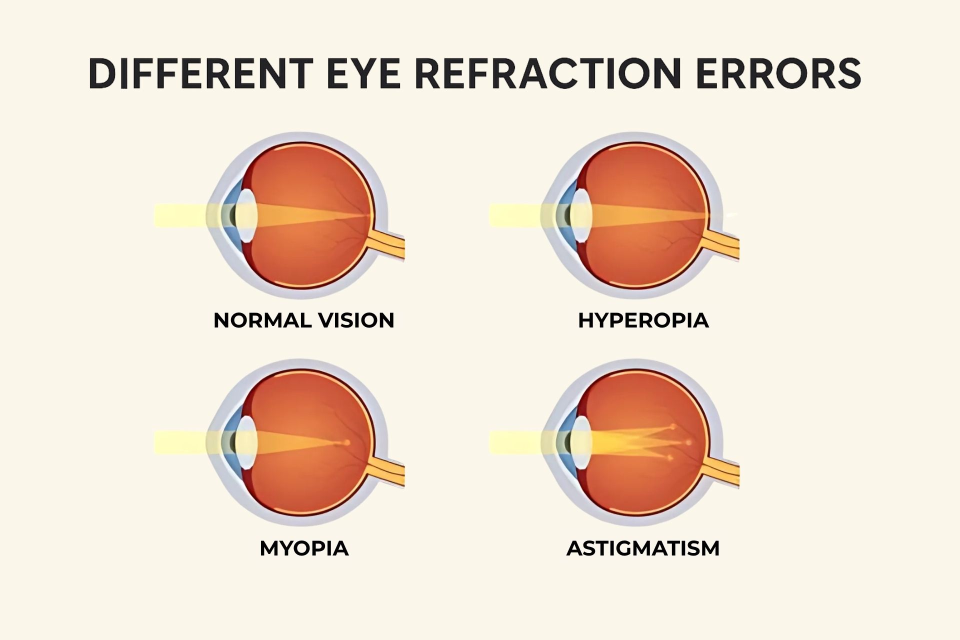 Is 20/40 Vision Bad? | EZOnTheEyes
