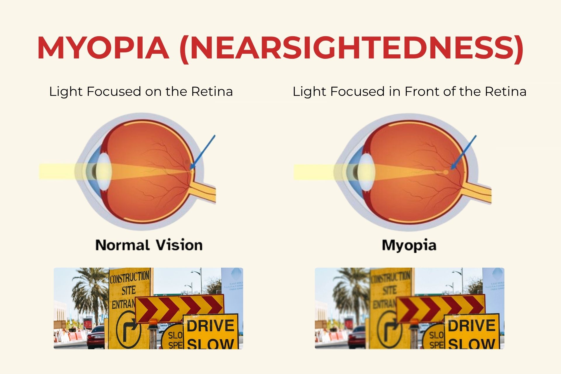 Contact Lenses For Myopia | EZOnTheEyes