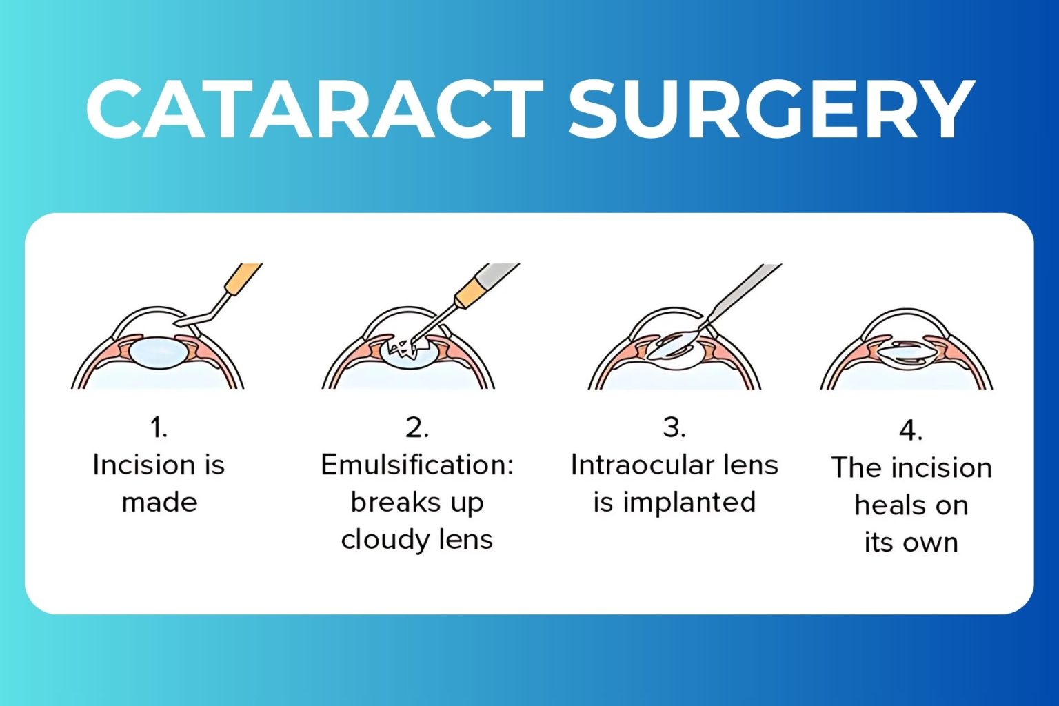 How Long Between Cataract Surgery on Each Eye: Optimal Timing Explained ...
